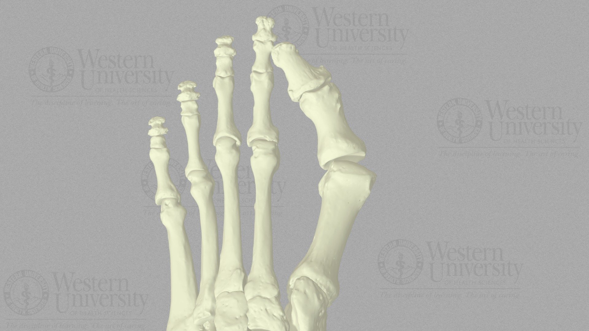 Lapidus Procedure - 3D model by WesternU3D [f7e7264] - Sketchfab