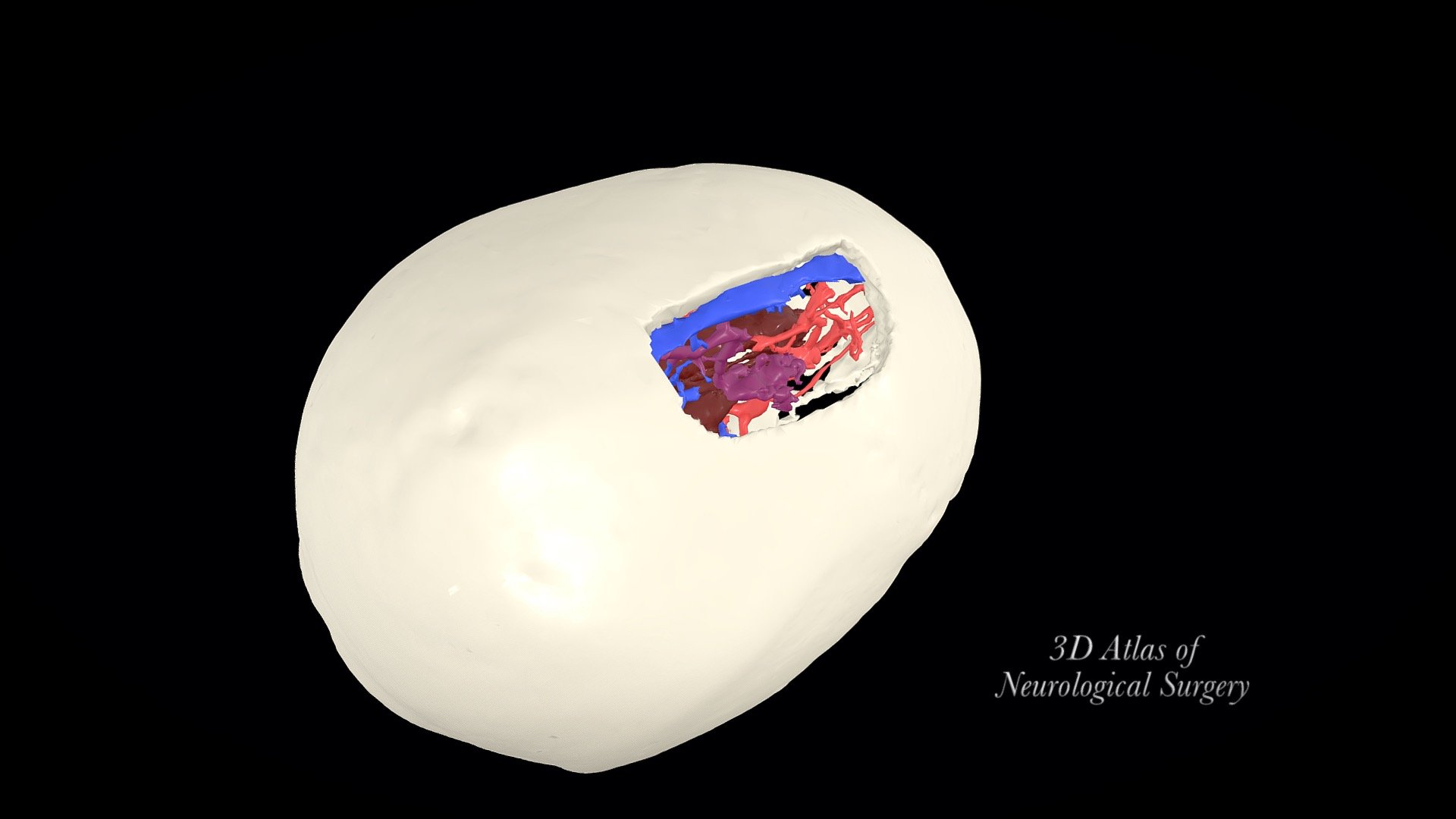 Right Parasagittal Craniotomy Pericallosal AVM - 3D model by 3D Atlas ...