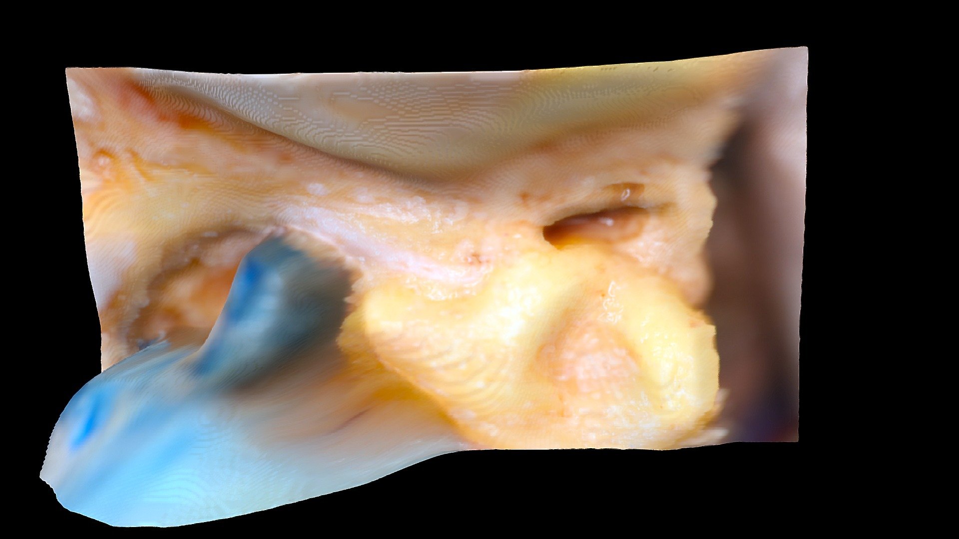 mastoidectomy - 3D model by skull base XR (@skullbasexr) [f92acfb ...