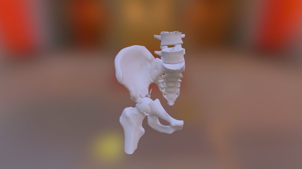 Acetabular Fracture - sku 235 - 3D model by orto3d [f94627f] - Sketchfab