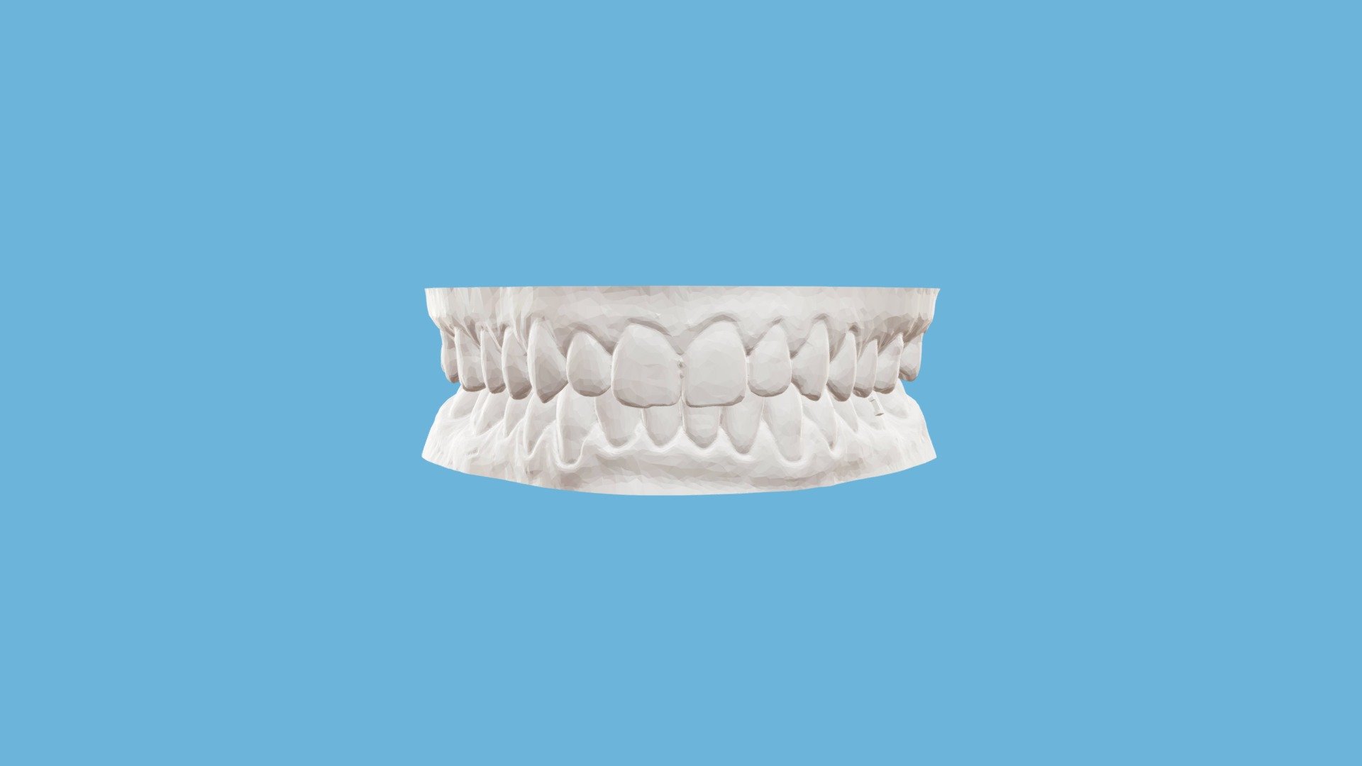 U3 - 3D model by ODL OrthoLab (@Odlortho) [f9546a8] - Sketchfab