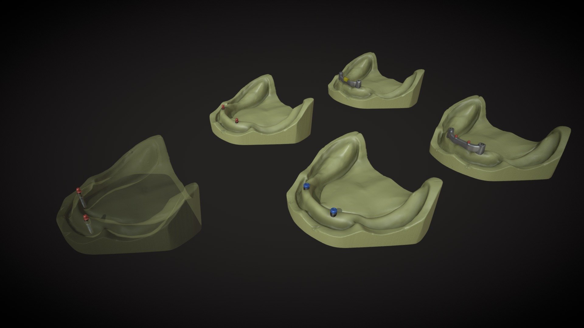 Mandibular Overdenture OD-1 and OD-2 - 3D model by Muhammad Nabeel ...