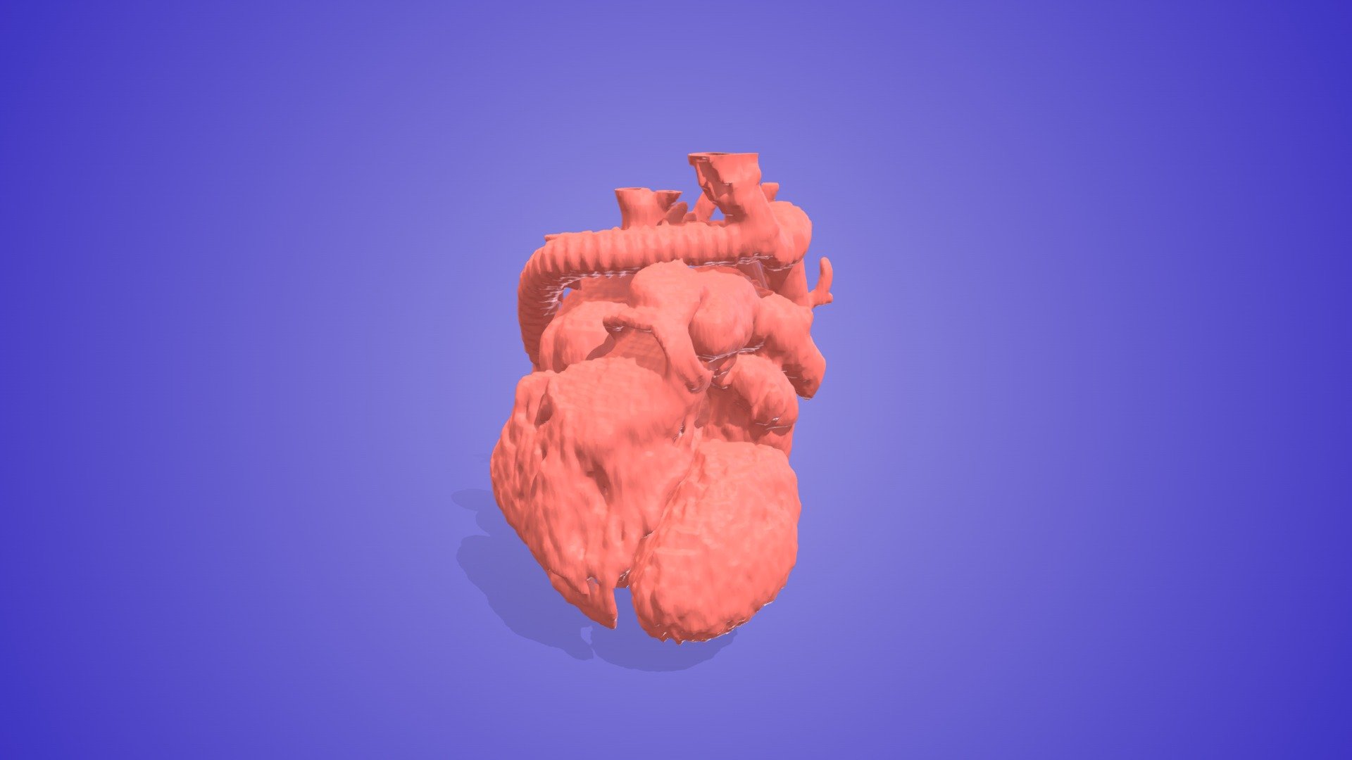 Unbalanced Atrial Ventricular Septal Defect AVSD - Download Free 3D ...