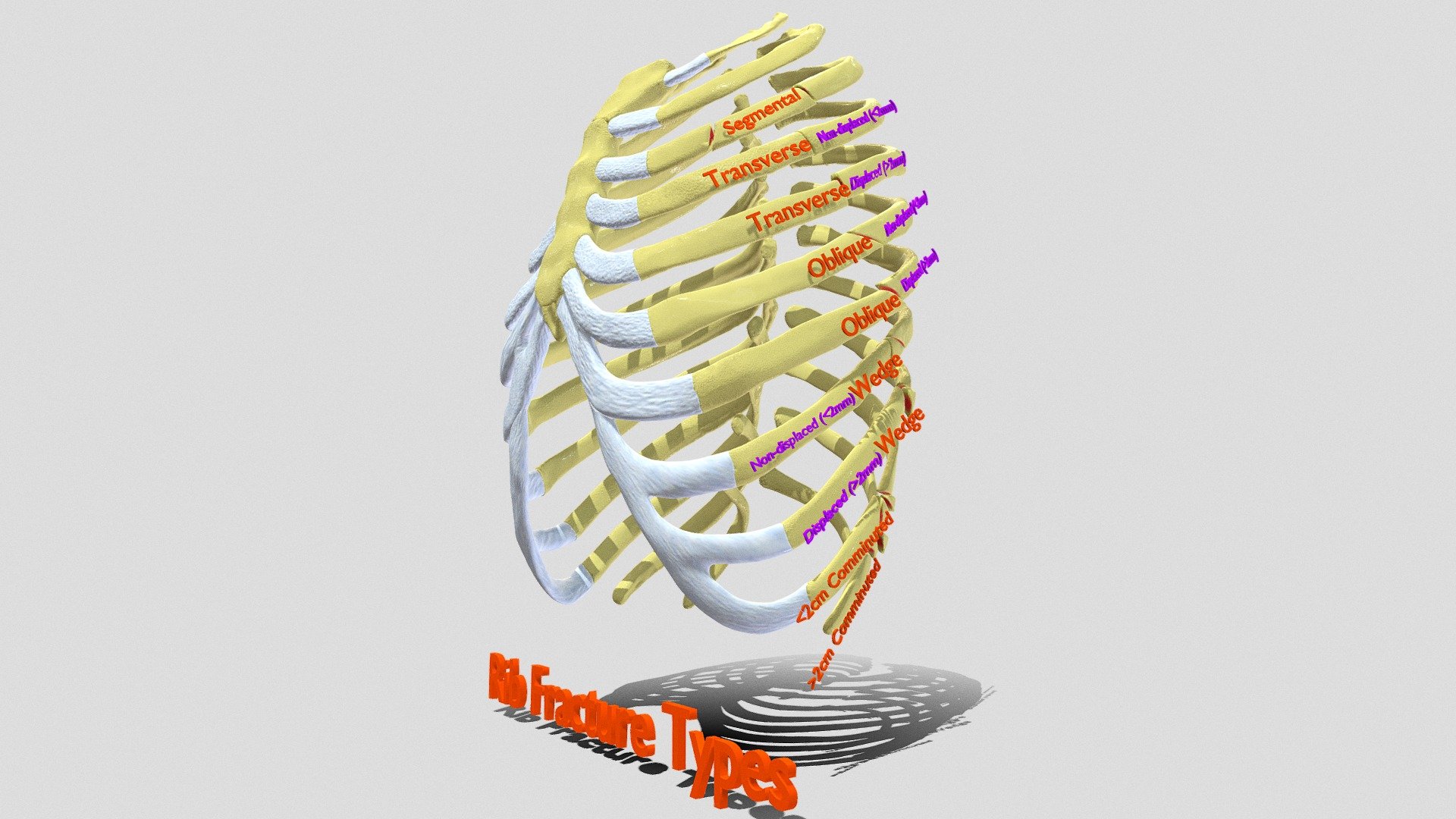 Rib fracture and its types - Buy Royalty Free 3D model by Deepankar ...