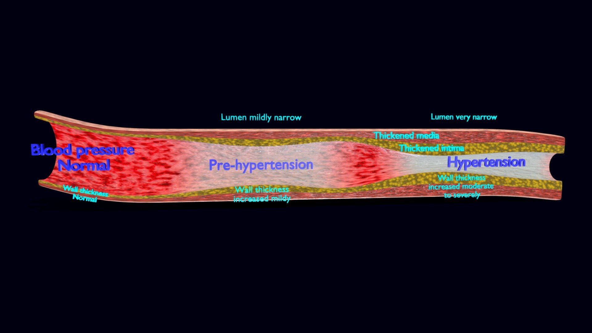 Hypertension blood vessel artery structure chang - Buy Royalty Free 3D ...
