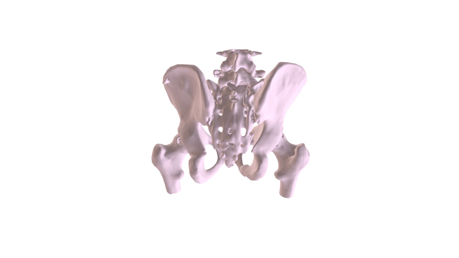 Fractured bone - 3D model by nayensky [fce29f0] - Sketchfab