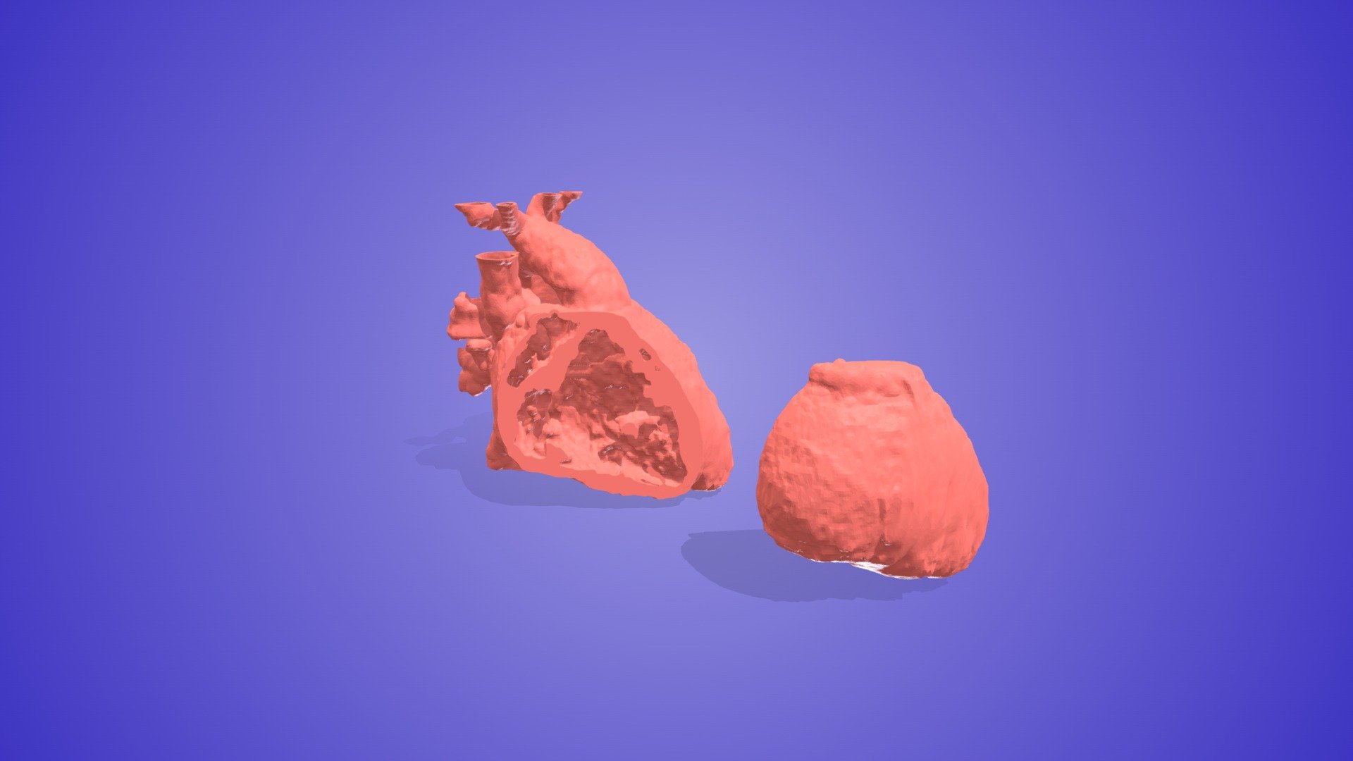Transposition of the Great Arteries and VSD - Download Free 3D model by ...
