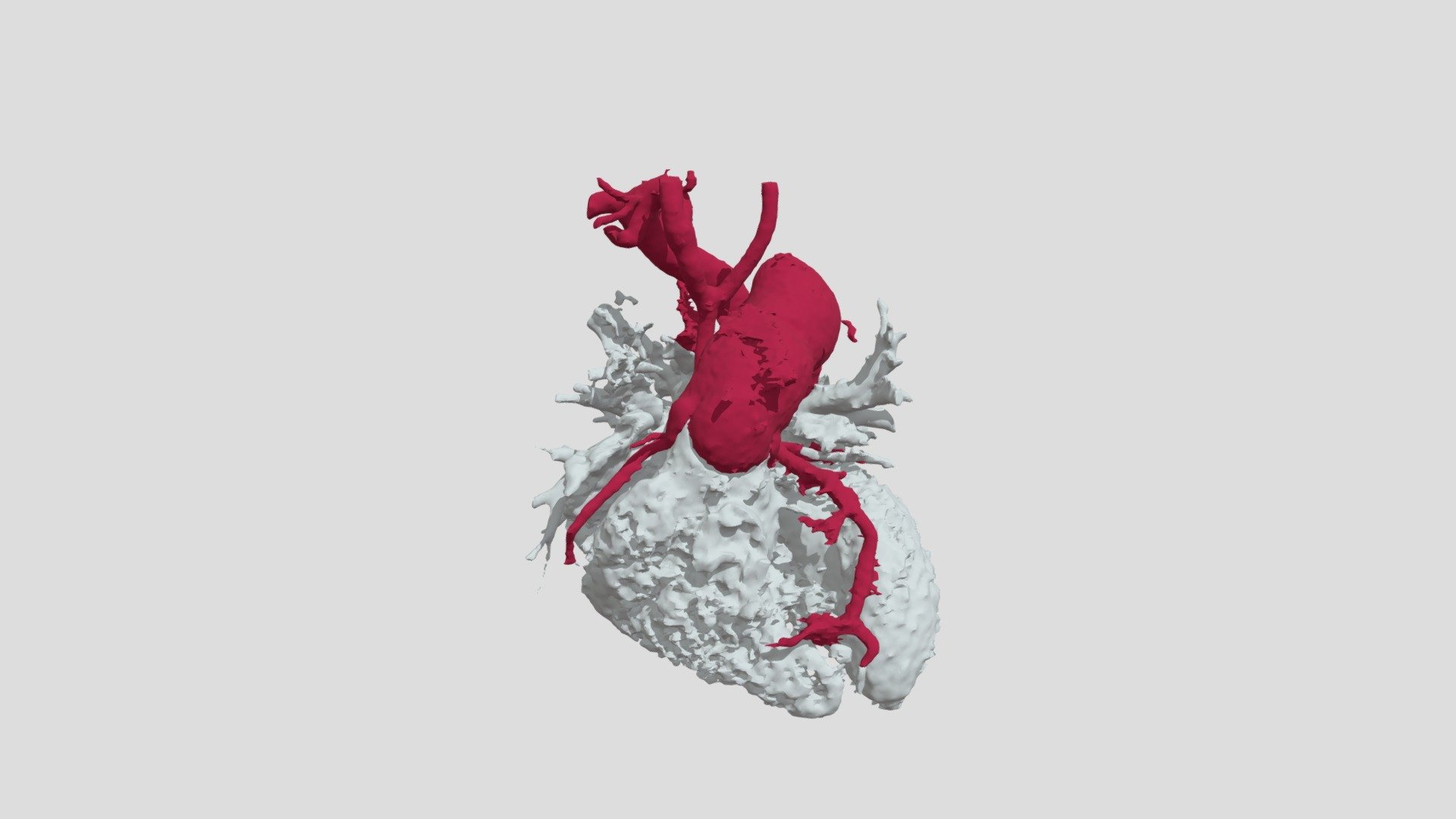 Hypoplastic Asc. Aorta, Unusual AO Arch (S0308) - 3D model by NCHS ...