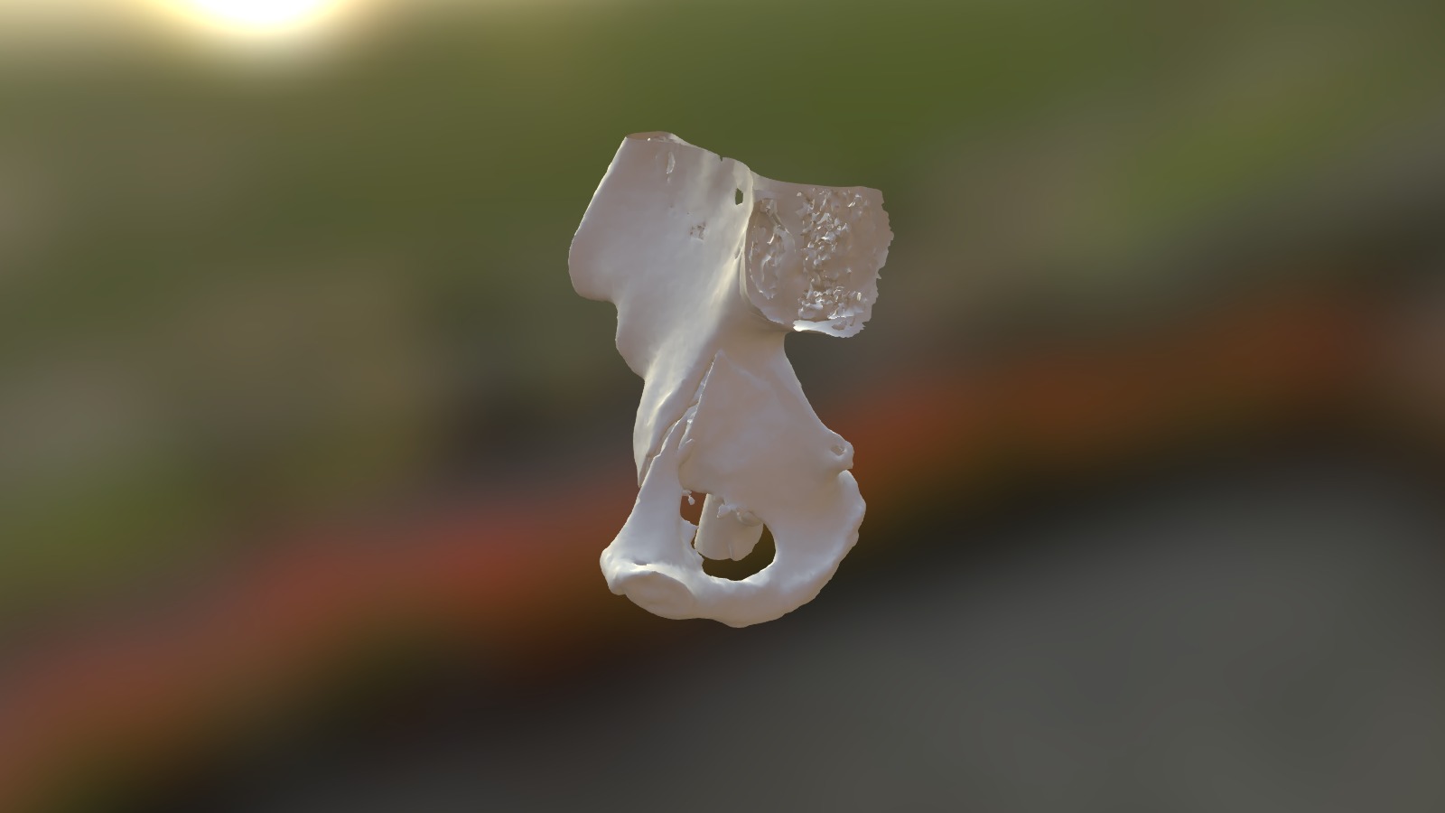 Acetabular Fracture - sku 239 - 3D model by orto3d [fd44019] - Sketchfab
