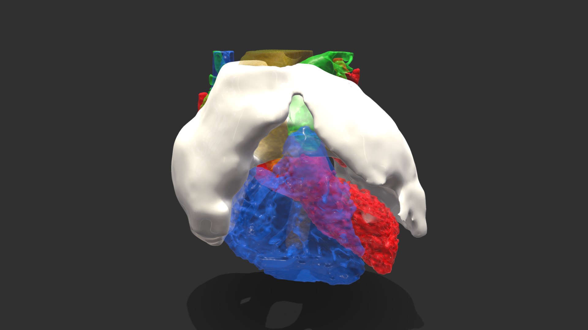 Complex Tumor - 3D model by APIL (@apil_tgh) [fd6926b] - Sketchfab