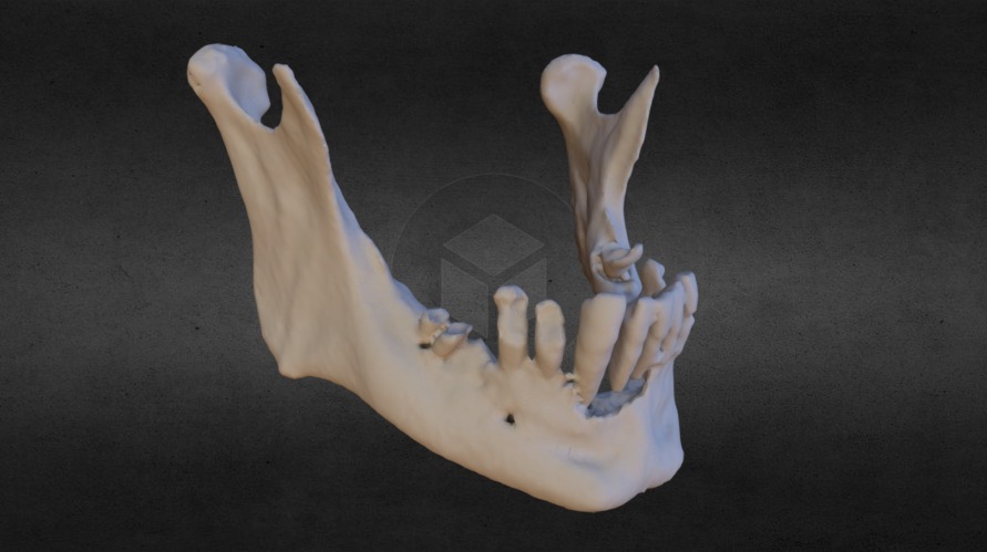 Segmental Mandibulectomy - 3D model by RPA IAS (@kai.cheng) [fd76593 ...