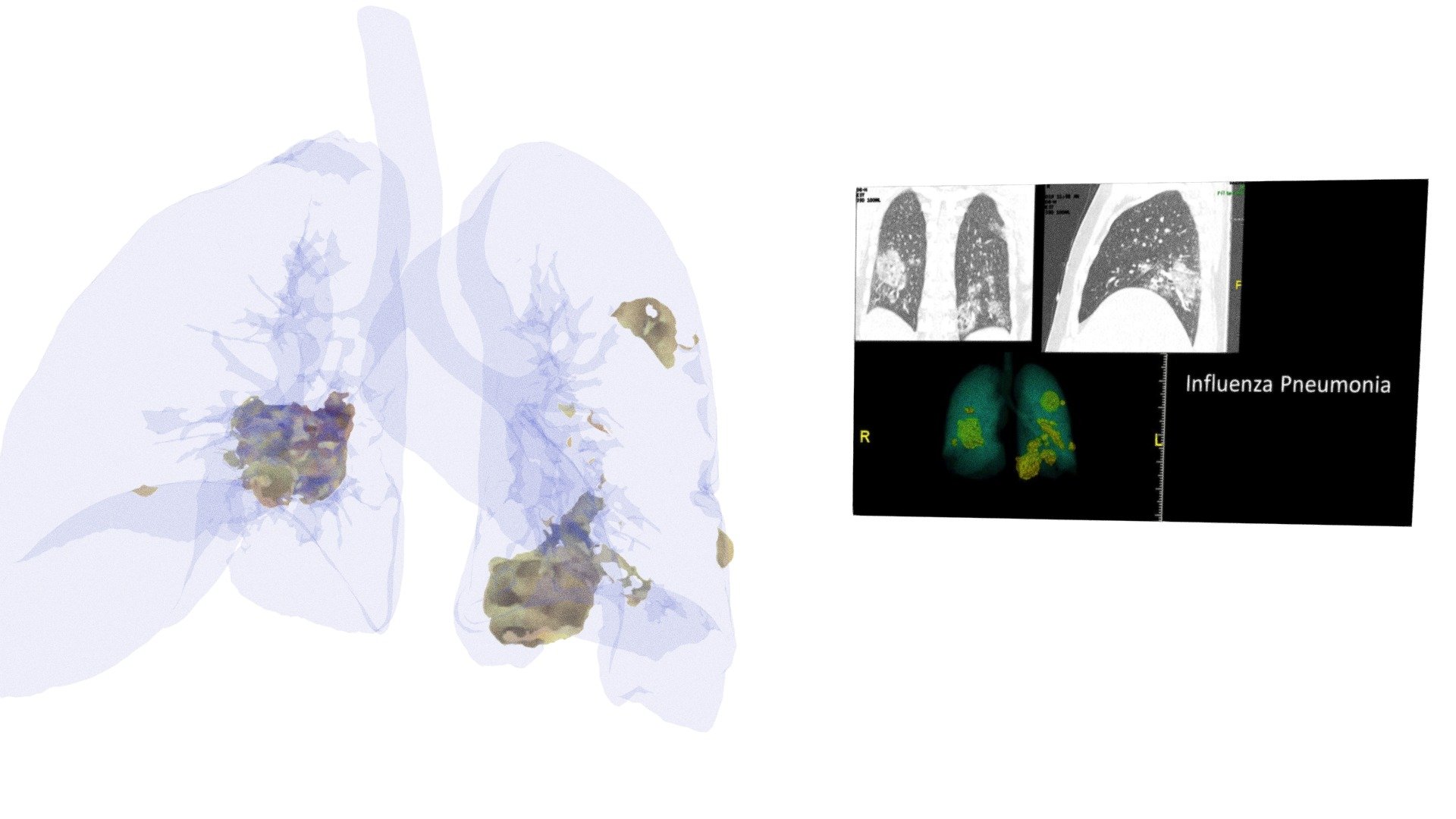 Influenza Pneumonia - 3D model by tl0615 [fd89e18] - Sketchfab