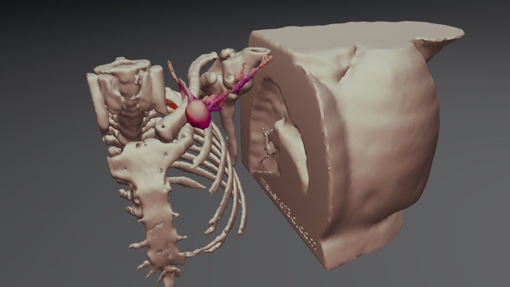 # 046 Breast Tumor - 3D model by makerof3d [fdb5838] - Sketchfab