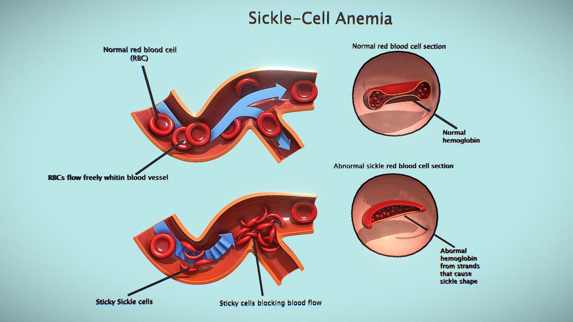 Sickle-Cell Anemia - 3D model by arloopa [fe94991] - Sketchfab