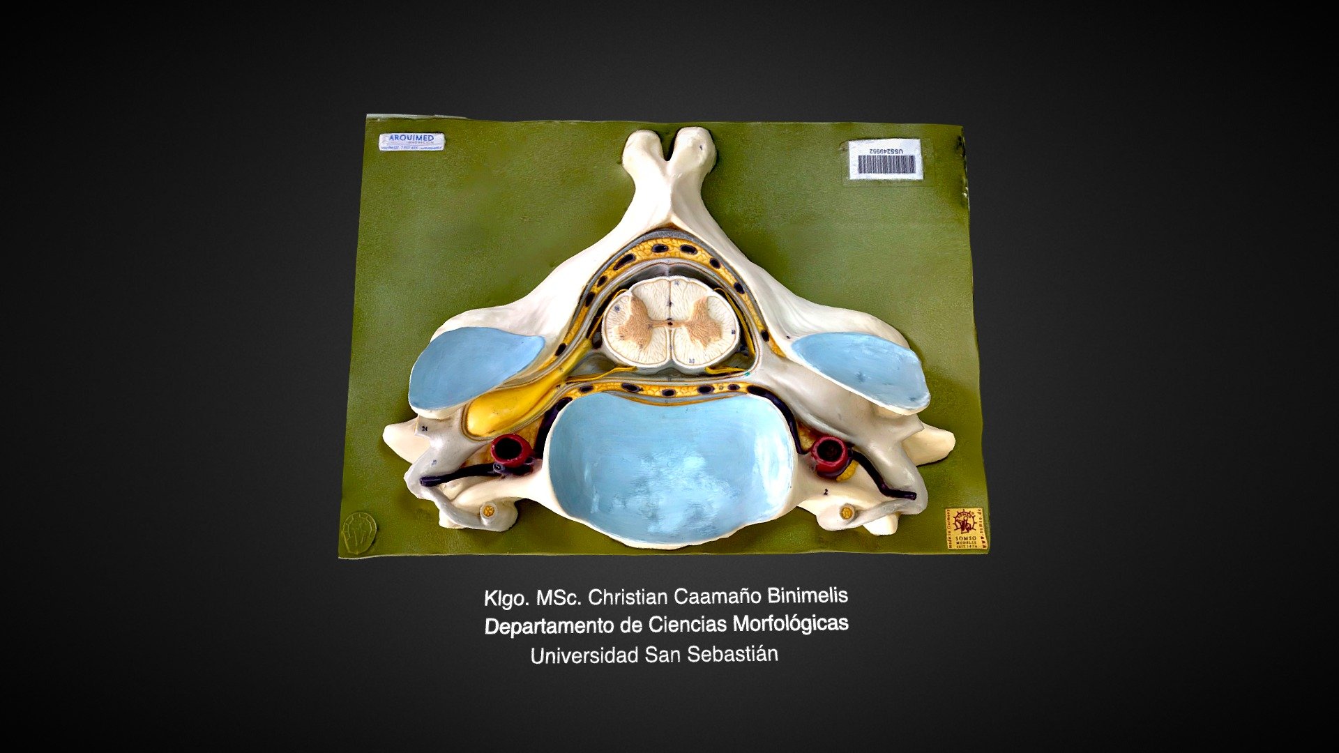 Médula Espinal en Vértebra Cervical - 3D model by Klgo. MSc. MBA ...